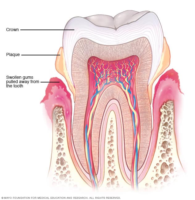 5 Ways Clear Braces Help Maintain Healthy Gums