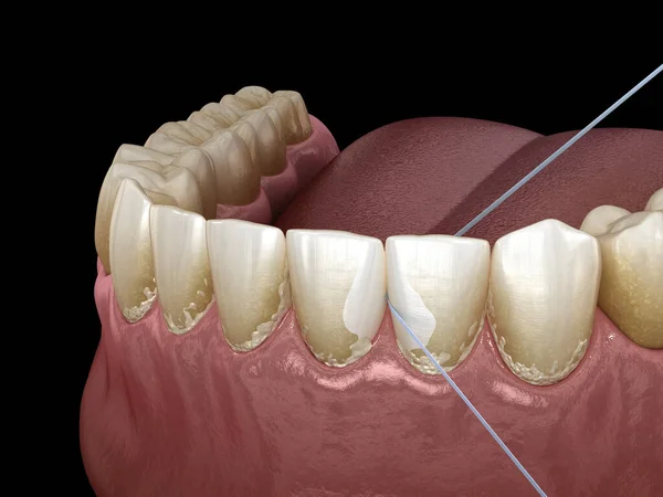 Plaque Build-Up vs. Tartar: Understanding the Differences - Colorado ...