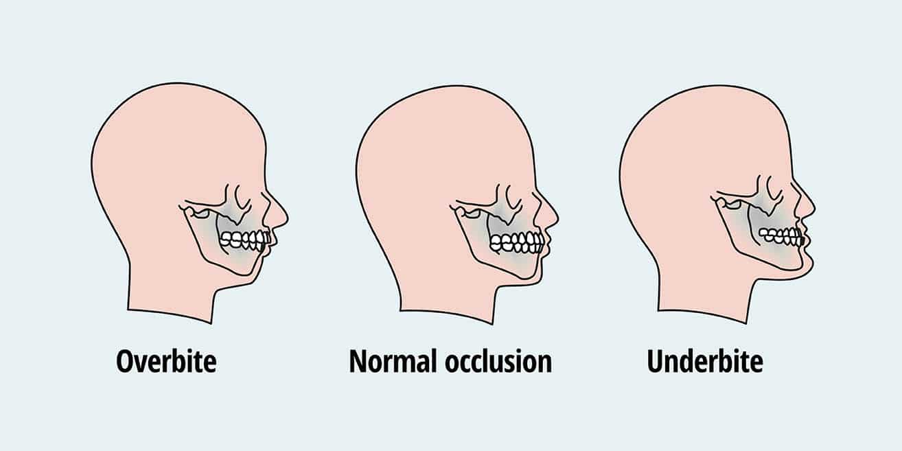 Overbite, Underbite & Crossbite: What’s Normal? | Clermont Dental