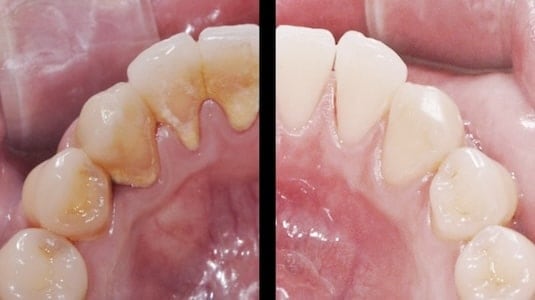 Deep Cleaning: Scaling & Root Planing for Gum Health